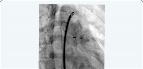 Deployment Of Amplatzer Asd Cardiofix 8 Mm Through Aortopulmonary