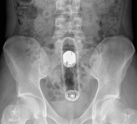 Pin On Foreign Body X Rays