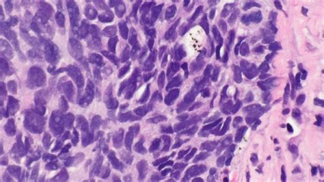 Triple Therapy For Squamous Nsclc Shows Real World Clinical Benefit Rnsclc