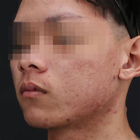 Oily And Acne For Men Hanbang Skin Solutions