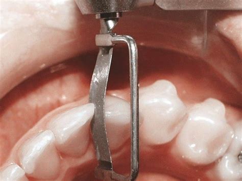 Aligner Ipr Instrumente Orthoby Feldmann Dental