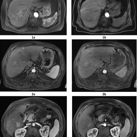 Diagram Of Showing How The Inverse Deformation Field Is Used To Warp Download Scientific