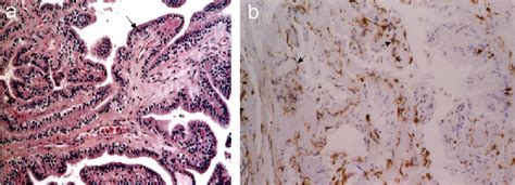 A Choroid Plexus Papilloma With Evident Papillary Architecture