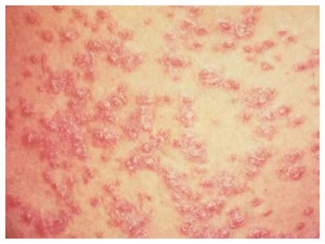 Presentation Of Streptococcus Pptx