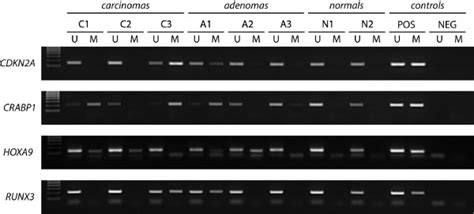 Representative Methylation Results In Colorectal Tumors And Normal