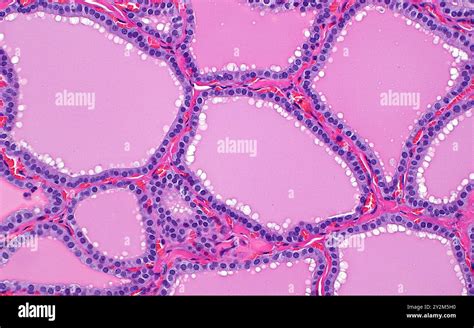 Light Micrograph Of Thyroid Follicles In Graves Disease One Of The