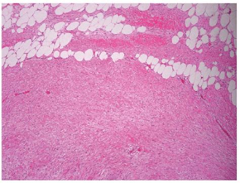 Benign And Reactive Stromal Lesions Basicmedical Key
