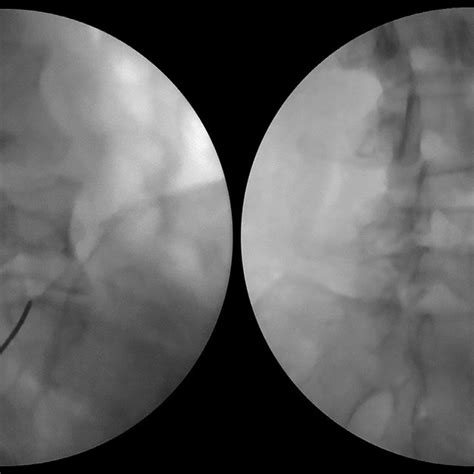 The Final Parallel Placement Of The Cryoprobe To The L4 L5 Facet Joint Download Scientific