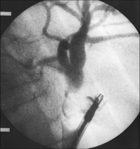 The Importance Of Intraoperative Cholangiography During Laparoscopic Cholecystectomy PMC