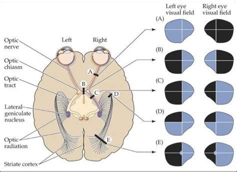 Pituitary Gland Tumor Visual Field Clinically Nonfunctioning Pituitary