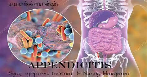 What Is Appendicitis Facts About Appendicitis Infographic