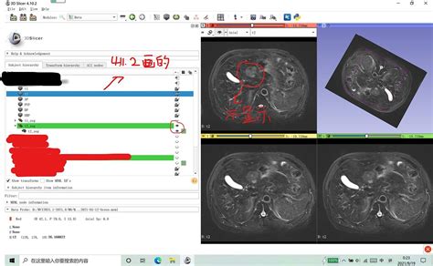 请问用4 11版本画的segmentation在4 10 2版本通过sence打开后不显示segmentation 问题求助 3DSlicer中文论坛