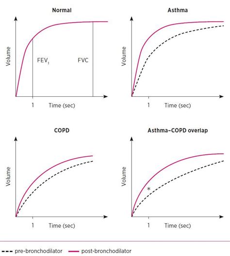 Managing The Overlap Of Asthma And Chronic Obstructive Pulmonary