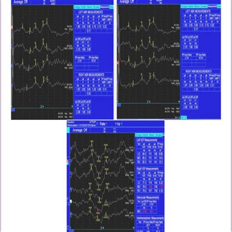 Baeps Latencies Are Bilaterally Normal Up Vep Pattern Reversal Download Scientific Diagram