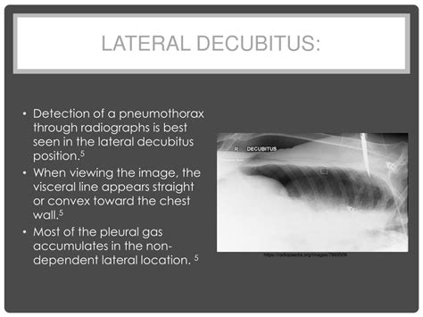 Ppt C31 Pneumothorax Powerpoint Presentation Free Download Id586391
