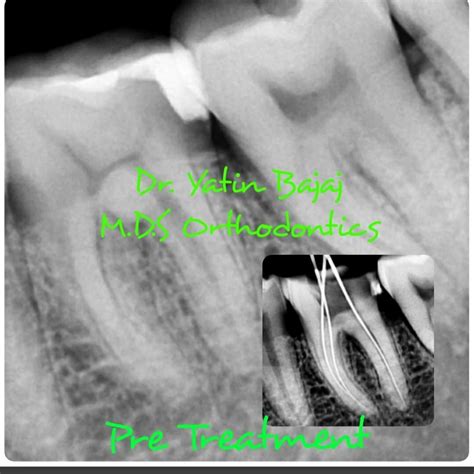 Case Report Of File Bypass Done In Mandibular First Molar Restoration