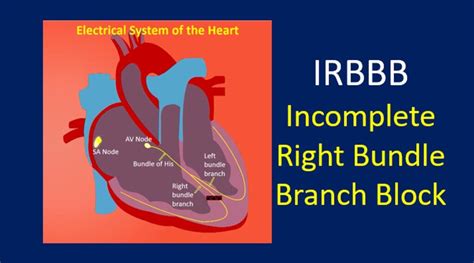 What Is Irbbb All About Heart And Blood Vessels