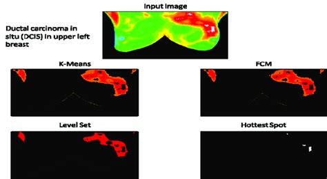 Hot Region Segmentation Of Dcis Patient Thermogram Download Scientific Diagram