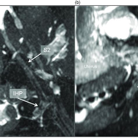 Coronal Schematic Drawing Of The Autonomic Pelvic Plexus A And The Download Scientific Coronal Schematic Drawing Of The Autonomic Pelvic Plexus A And The Download Scientific