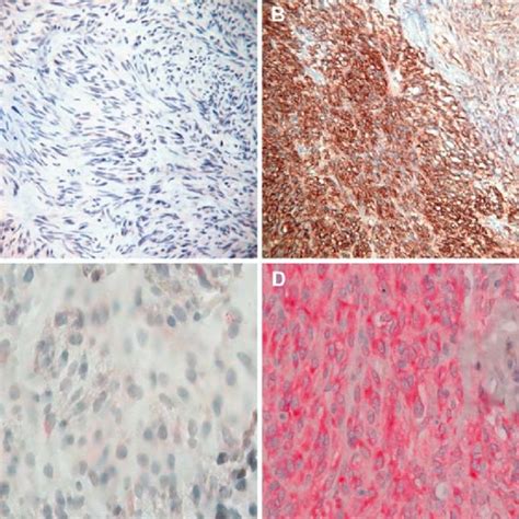 Kit Mutations In Gists A Amino Acid Sequence Of Kit Exon 11mutations Download Scientific