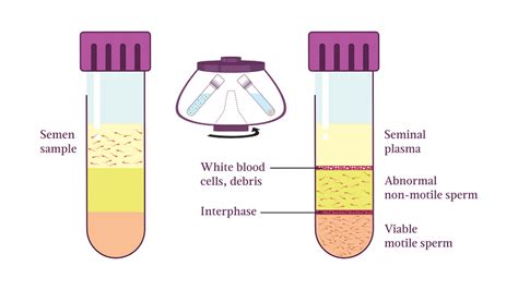 How Double Density Gradient Centrifugation Impacts Sperm Quality San