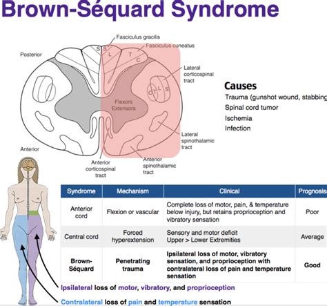 Brown Sequard Syndrome Medical Knowledge Basic Anatomy And
