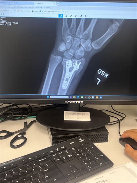 Distal Radius Plate Collapse R Brokenbones