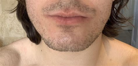 Angular Cheilitis Scarring R Skincareaddictionuk