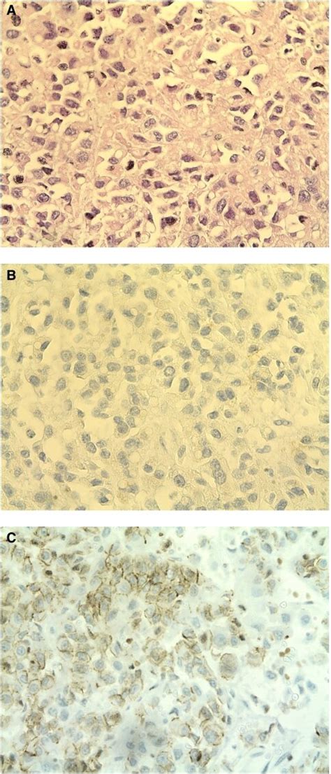 he staining and ihc staining for snail and e cadherin in a