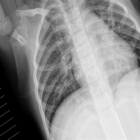 Single Label Classification Of Lung Diseases Classification Dataset V2