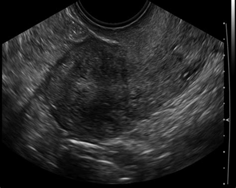 Endometrial Ablation Normal Imaging Appearance And Delayed