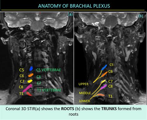 Brachial Plexus Anatomy Mri Brachial Plexus Mri Anatomy Human