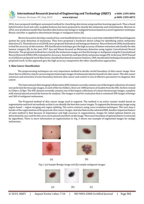 Irjet Color And Texture Based Feature Extraction For Classifying Skin Cancer Using Support