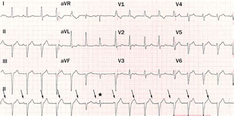 Brugada Algorithm Vt Vs Aberrant Svt Ecg Book