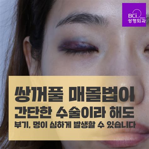 쌍꺼풀 매몰법 수술 후 시간에 따른 붓기 변화 중년눈성형 잘하는 비씨아이 눈매교정 눈성형의 모든것 비씨아이 성형외과