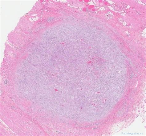 Nodular Fasciitis Atlas Of Pathology