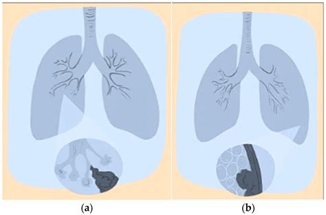 Lightweight Advanced Deep Neural Network Dnn Model For Early Stage Lung Cancer Detection