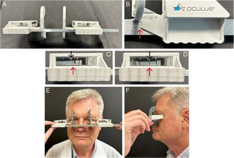 Enophthalmos Historical Perspective On Definitions Measurement Devices And Clinical