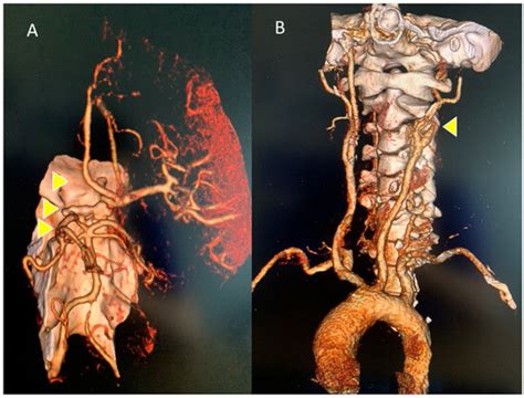 Aggressive Vaccine Induced Immune Thrombocytopenia And Thrombosis In A