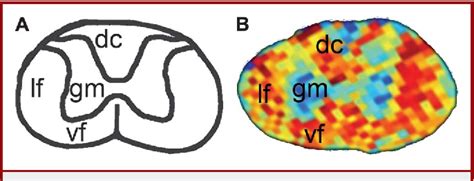 Figure 1 From Diffusion Tensor Imaging Of The Spinal Cord Insights