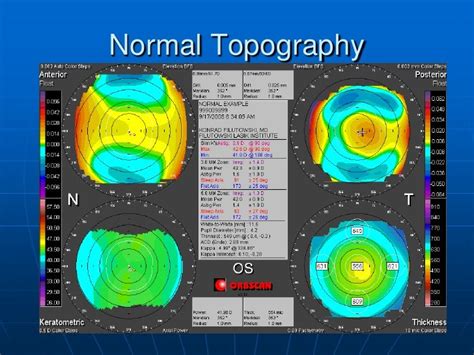 Normal Corneal Topography