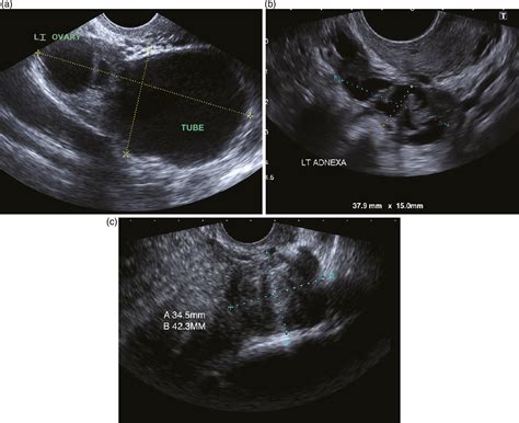 Abnormal Ovary Ultrasound