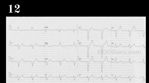 Normal Electrocardiography For Medical And Nursing Students Pptx