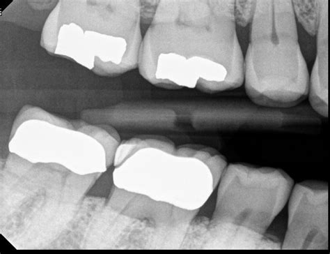 Interproximal Space Closure Options Bauer Smiles