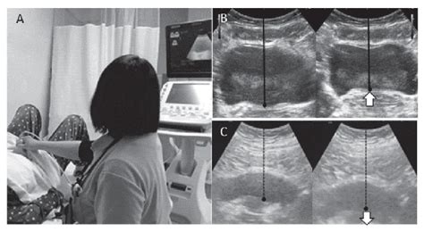 Evaluation Of The Pelvic Floor Muscles With Transabdominal Ultrasound