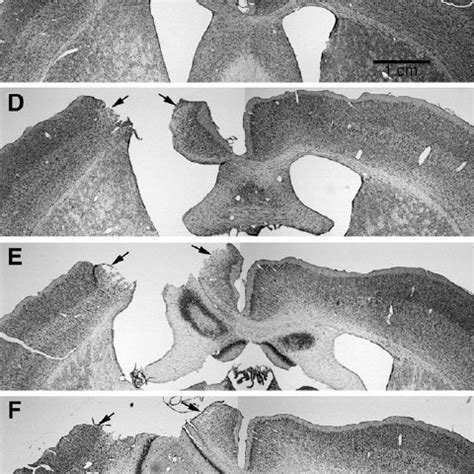 Reconstruction Of A Lesion Of The Sensorimotor Cortex In A Download Scientific Diagram
