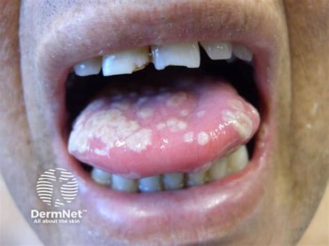 Mild Herpes Tongue