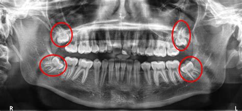 Impacted Wisdom Tooth