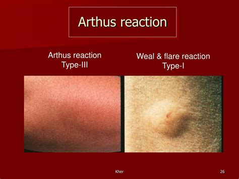Ppt Hypersensitivity Powerpoint Presentation Free Download Id1728689