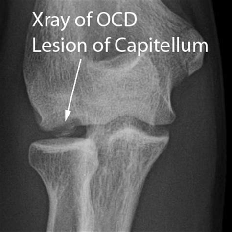Ocd Lesion Info About The Ocd Lesion